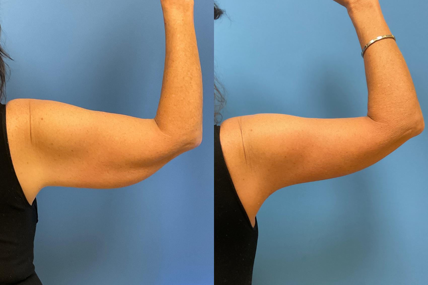 Arm Lift Before & After Photos Patient 300 | Webster, TX | Houston ...